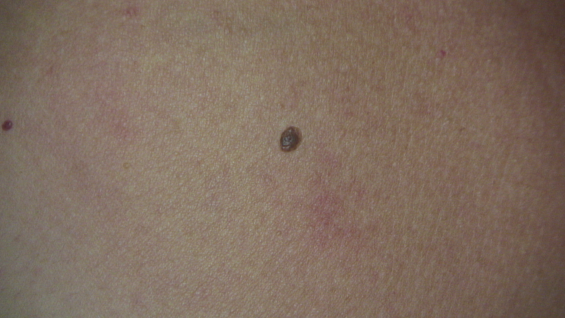 Harmlose Muttermale – Fachgruppe Dermatologie Österreich